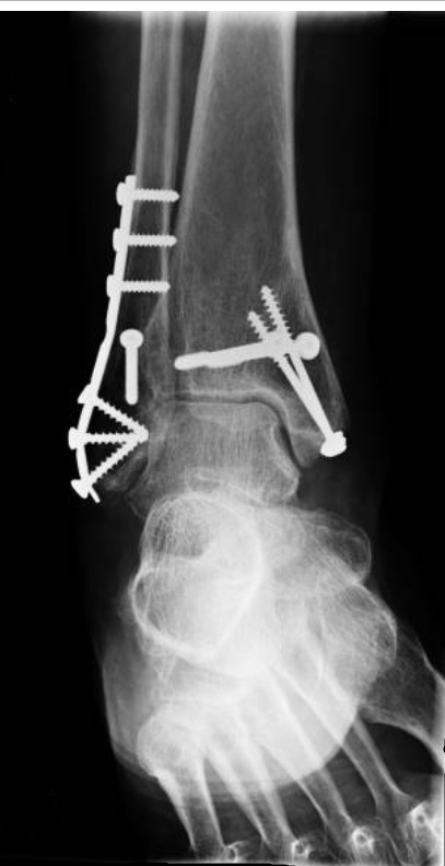 Ostéosynthèse Cheville - Dr. Benjamin GUENOUN