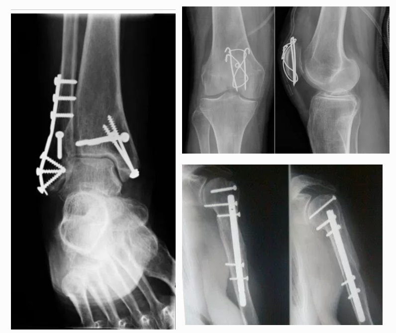 Ablation du Matériel d'Ostéosynthèse - Dr. Benjamin GUENOUN